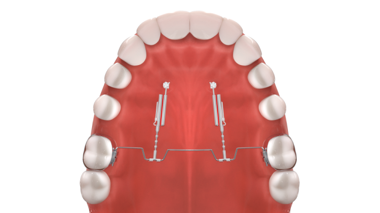 Hands-on course – TopJet Distalizer – Austria – RMO Europe